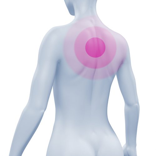 What is a Trigger Point?